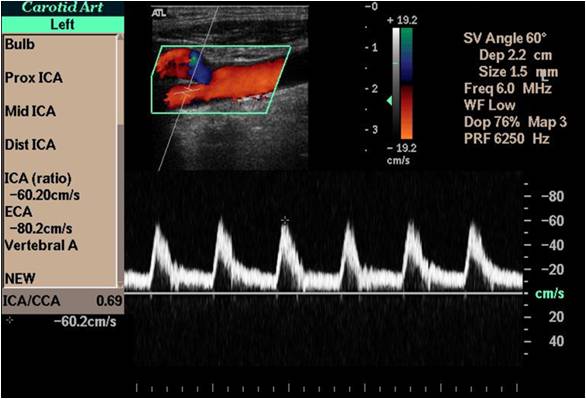 Vena Porta – Ecografía Fácil