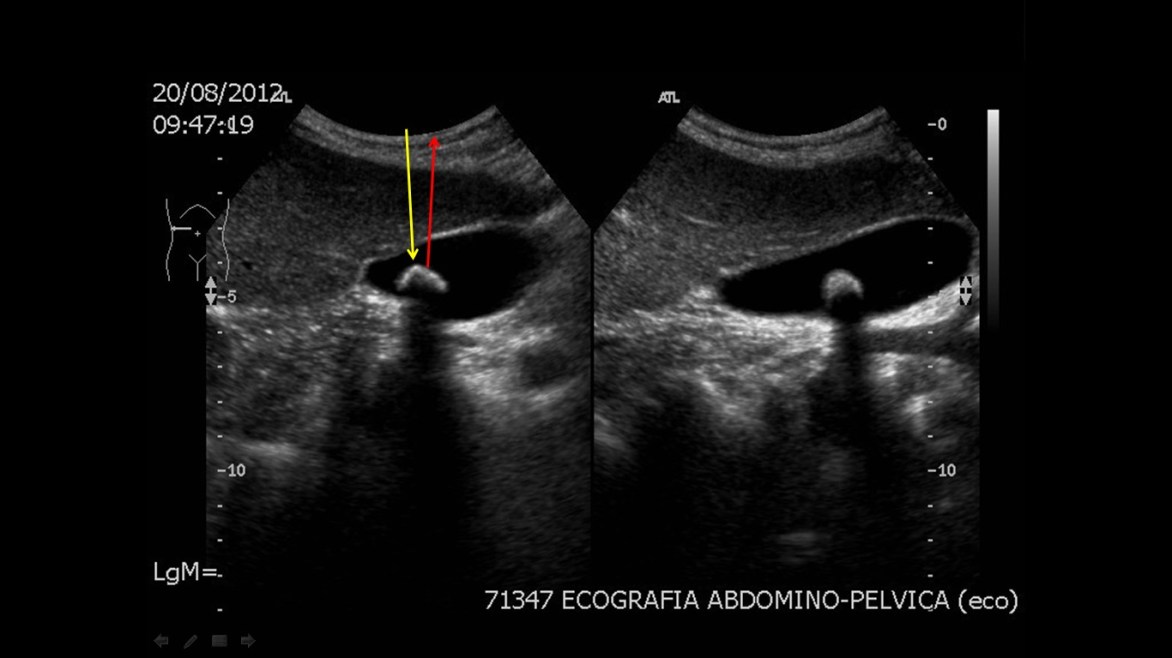 Refuerzo Posterior – Ecografía Fácil
