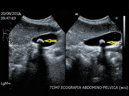 Isoecogénico – Ecografía Fácil