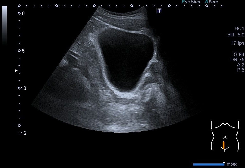 29. La Semiología Ecográfica. La Ecogenicidad. – Ecografía Fácil
