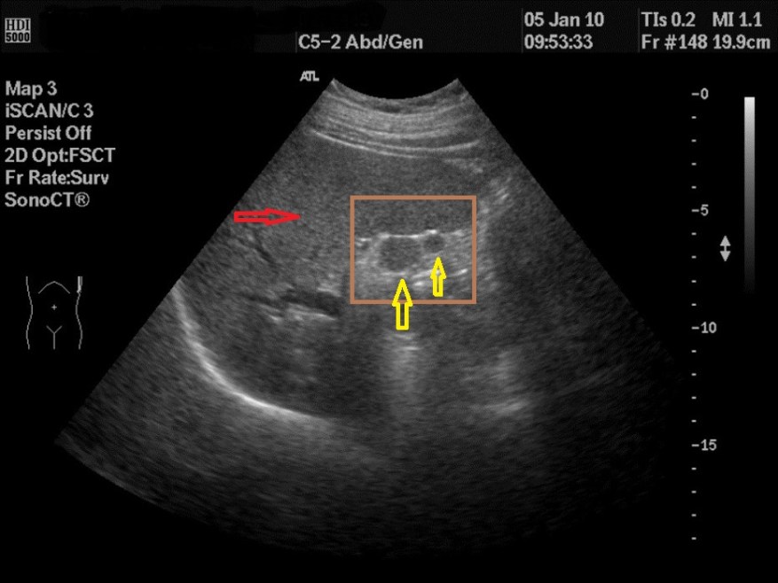 Isoecogénico – Ecografía Fácil