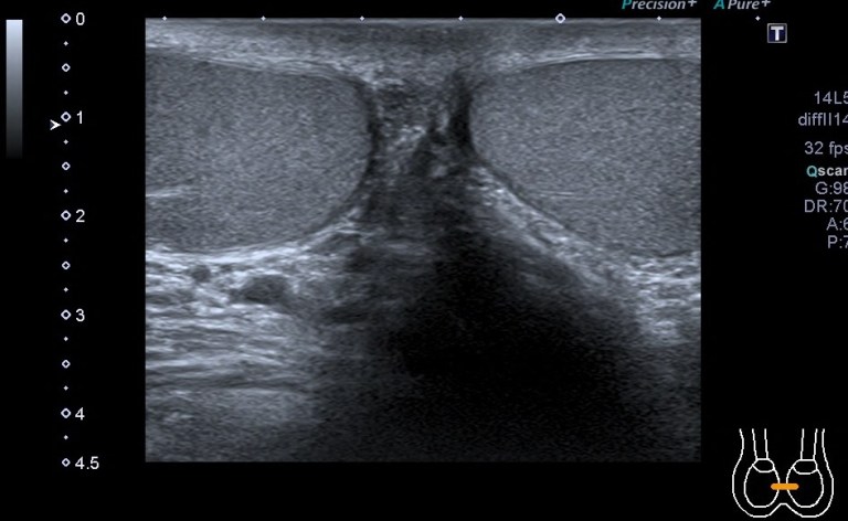 Isoecogénico – Ecografía Fácil