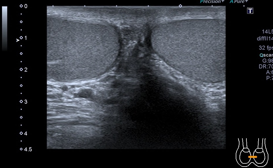 Isoecogénico – Ecografía Fácil