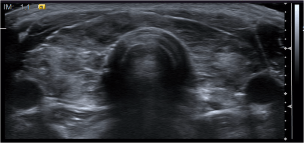 30. La Homogeneidad y la Heterogenicidad de la Imagen. – Ecografía Fácil