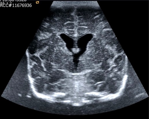 Isoecogénico – Ecografía Fácil