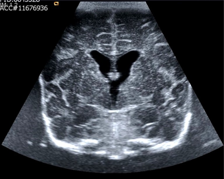 Isoecogénico – Ecografía Fácil