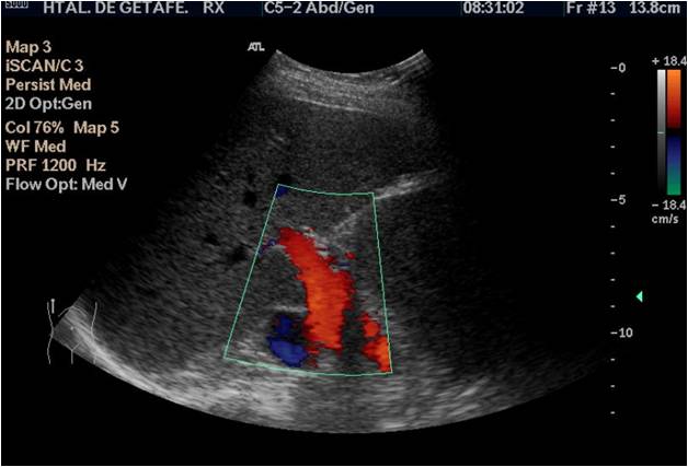 Vena Porta – Ecografía Fácil