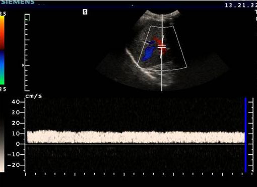 Vena Porta – Ecografía Fácil
