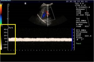 Vena Porta – Ecografía Fácil