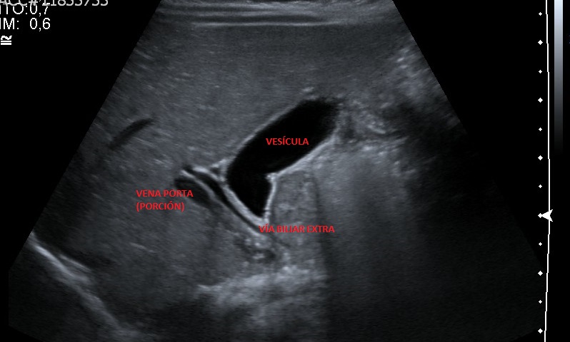 46. Protocolo de Abdomen. La Vesícula y Vías biliares. – Ecografía Fácil