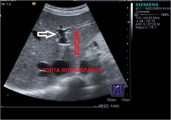 Imagen Anatómica De La Vena Porta Aneurisma De La Vena Porta. A
