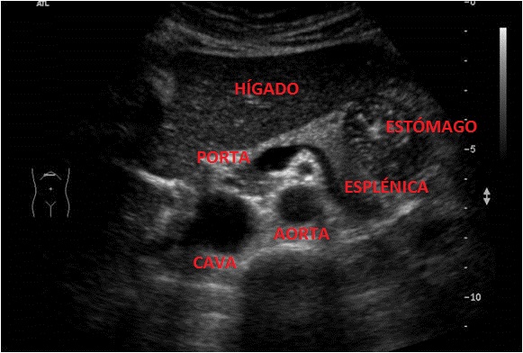 Wirsung – Ecografía Fácil