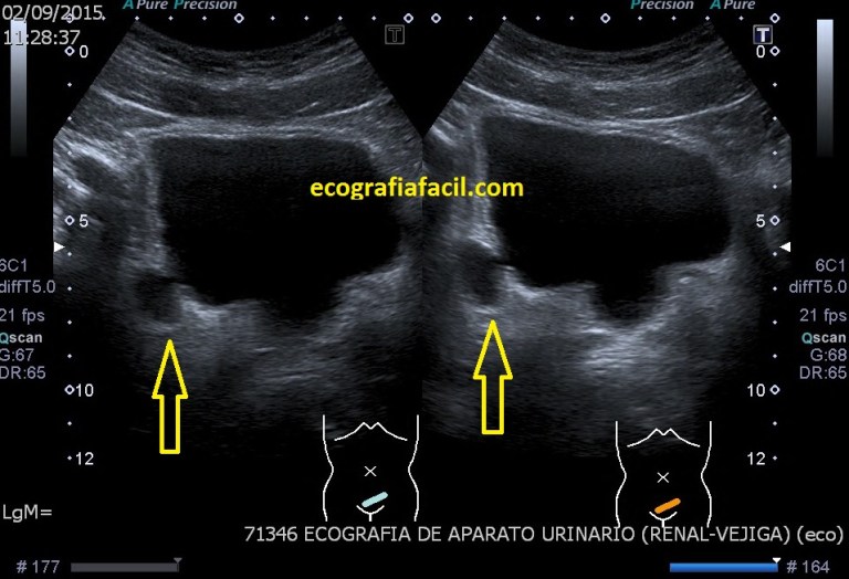 168. Urotelioma en Divertículo vesical. – Ecografía Fácil