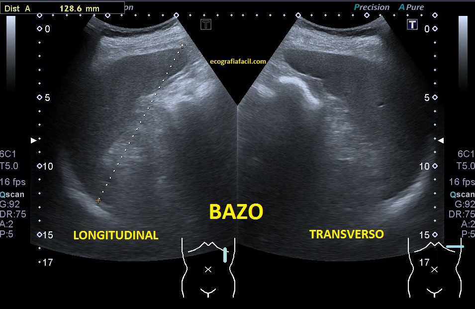 52. Protocolo de Abdomen. El Bazo. – Ecografía Fácil