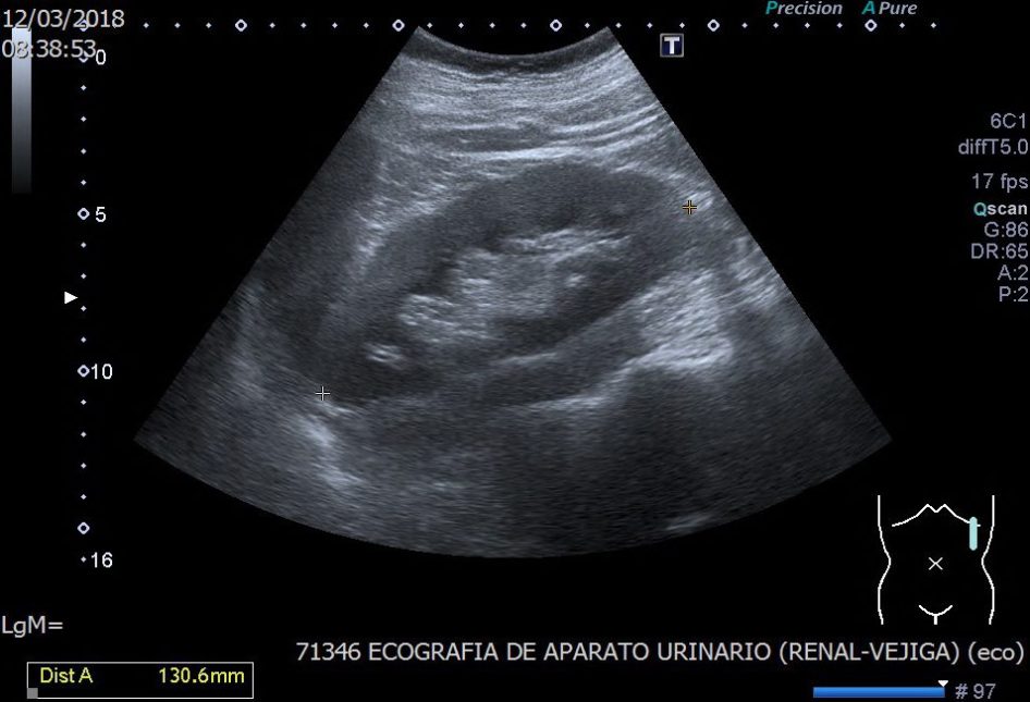 Hipoecogénico – Ecografía Fácil