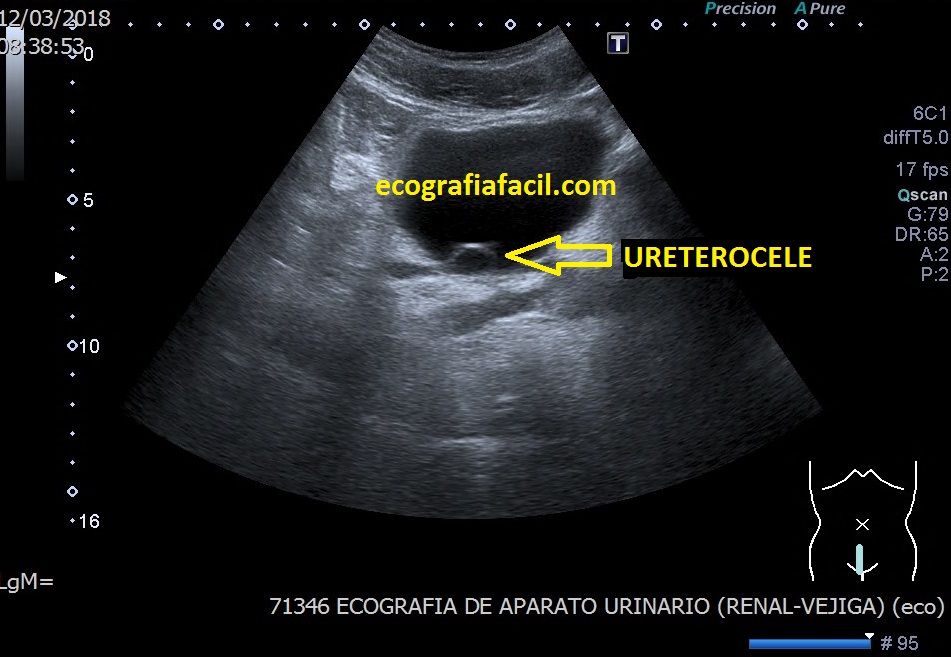 Vejiga – Ecografía Fácil