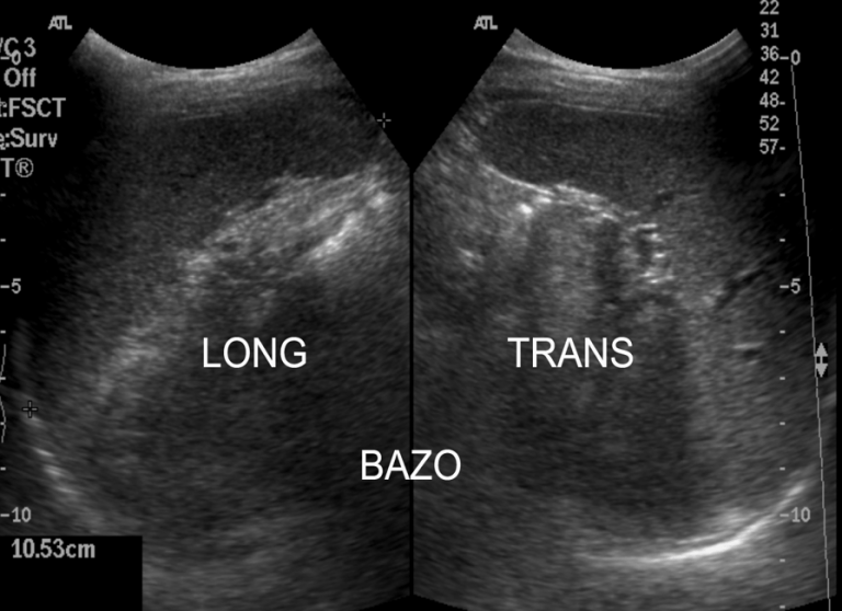 52. Protocolo de Abdomen. El Bazo. – Ecografía Fácil