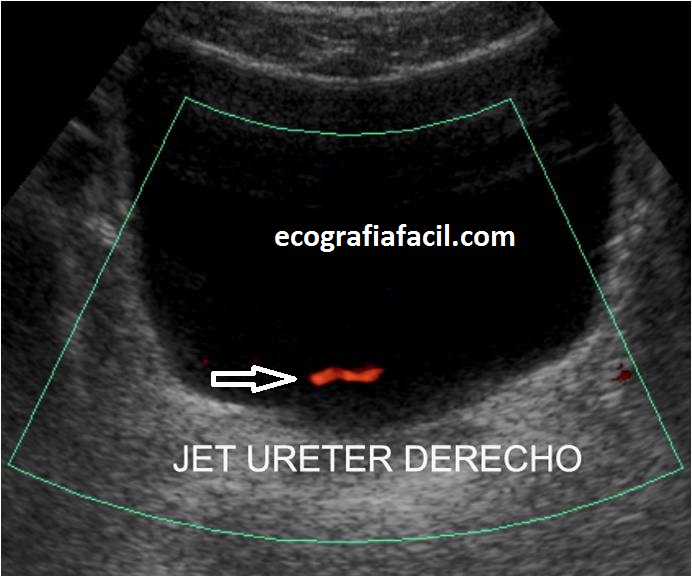 Vejiga – Ecografía Fácil
