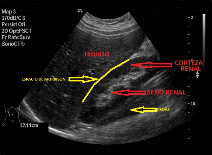 Espacio de Morrison – Ecografía Fácil