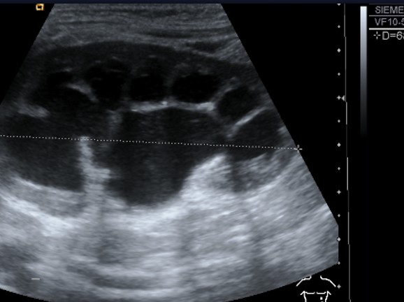 Hidronefrosis – Ecografía Fácil