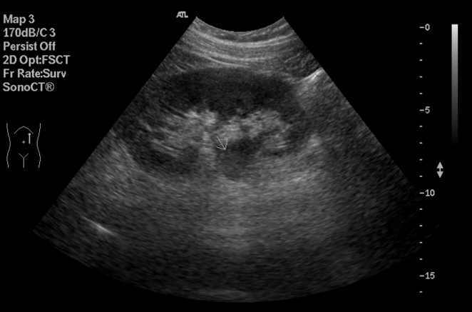Hidronefrosis – Ecografía Fácil
