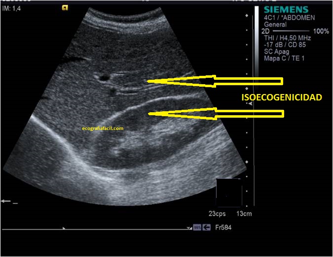 49. Protocolo de Abdomen. Relación Hepato-Renal. – Ecografía Fácil