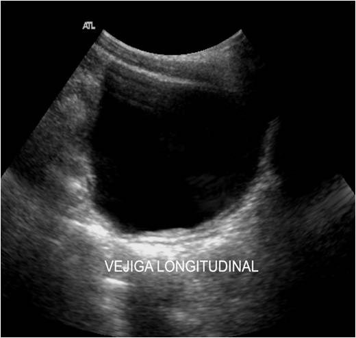Vejiga – Ecografía Fácil