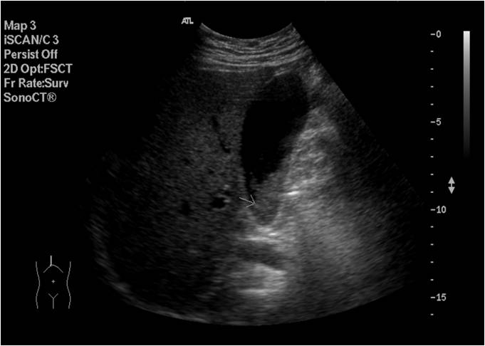 Vesícula – Ecografía Fácil