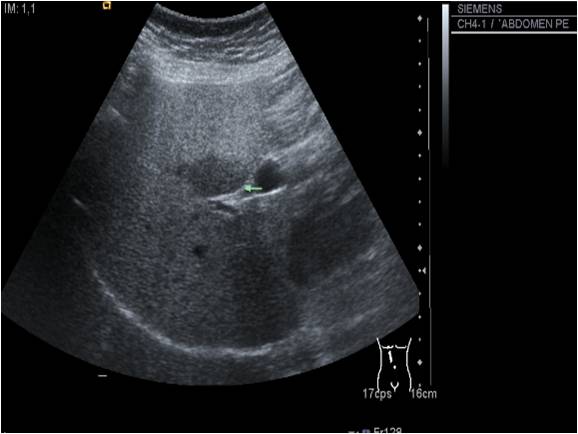 50. El Hígado. Patología más habitual. – Ecografía Fácil