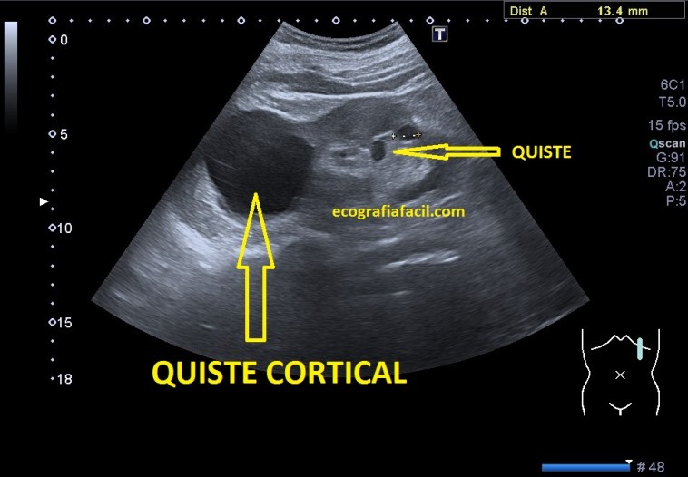 Quistes – Ecografía Fácil