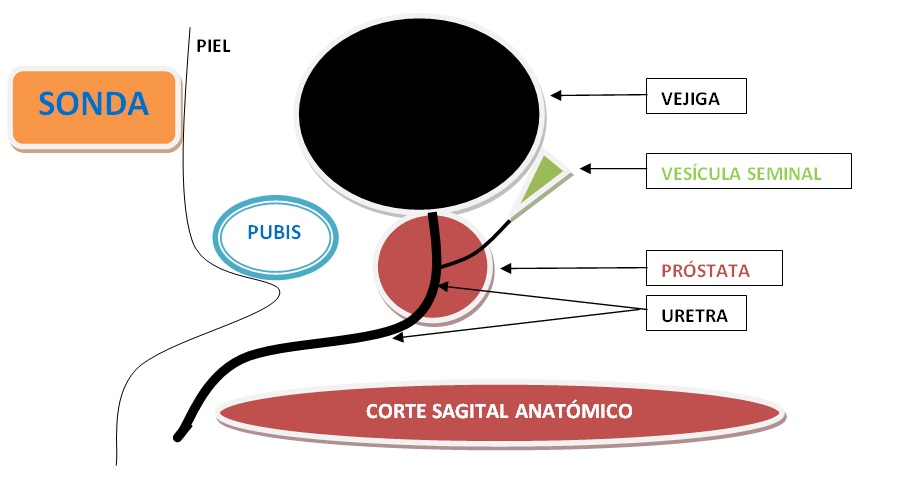 Vesículas Seminales – Ecografía Fácil