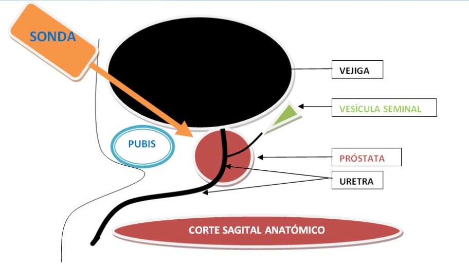 Vesículas Seminales – Ecografía Fácil