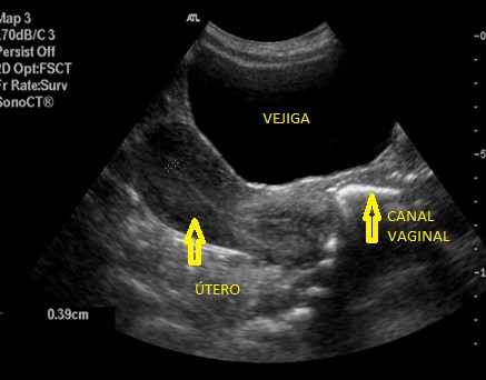 Vejiga – Ecografía Fácil
