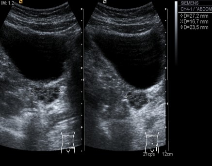 Ovarios – Ecografía Fácil
