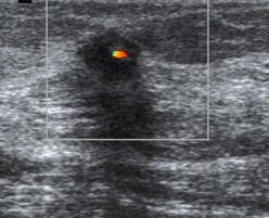 Quistes – Ecografía Fácil