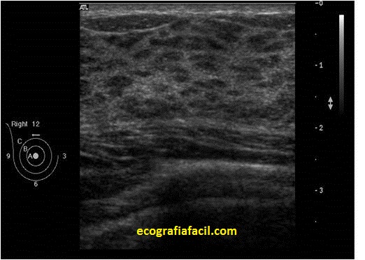 60. Protocolo de Mama. Exploración y tejido normal. – Ecografía Fácil