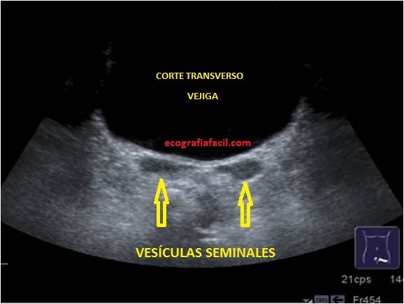 Vesículas Seminales – Ecografía Fácil