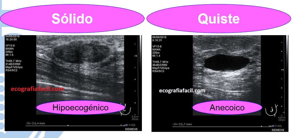 Quistes – Ecografía Fácil