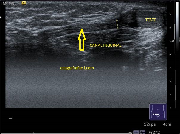 63. Patología escrotal habitual. – Ecografía Fácil