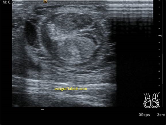 63. Patología escrotal habitual. – Ecografía Fácil