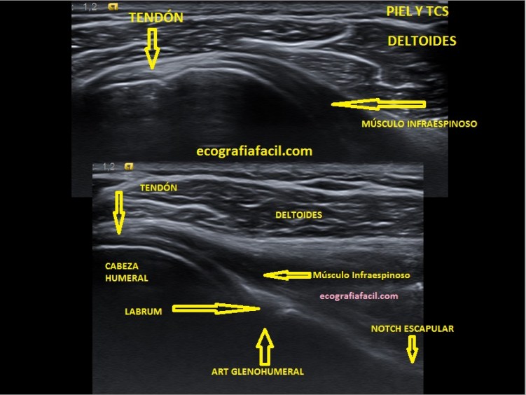 Hombro – Ecografía Fácil