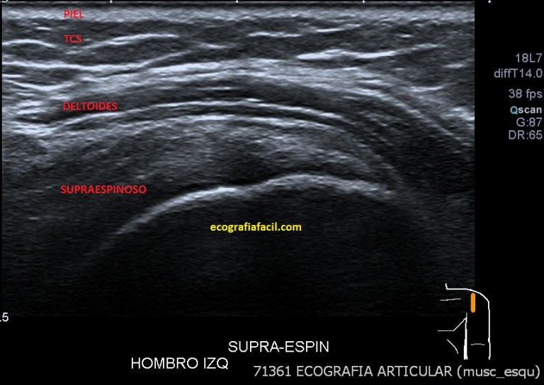 69. Protocolo de Hombro.Tendón del Supraespinoso. – Ecografía Fácil