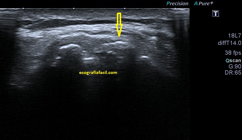 Bursitis – Ecografía Fácil