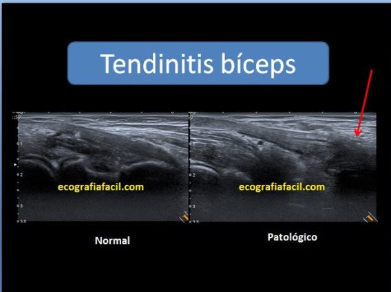 La Ecogenicidad – Ecografía Fácil