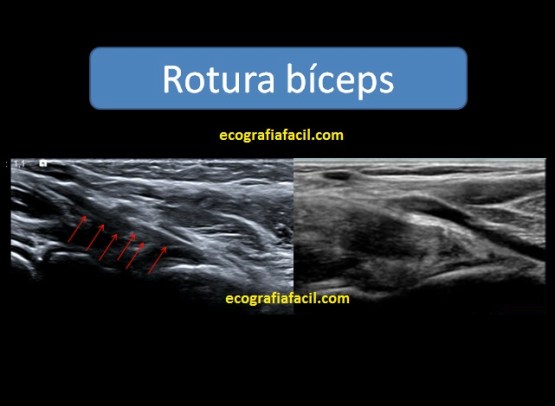 La Ecogenicidad – Ecografía Fácil