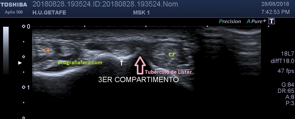 Región Extensora – Ecografía Fácil