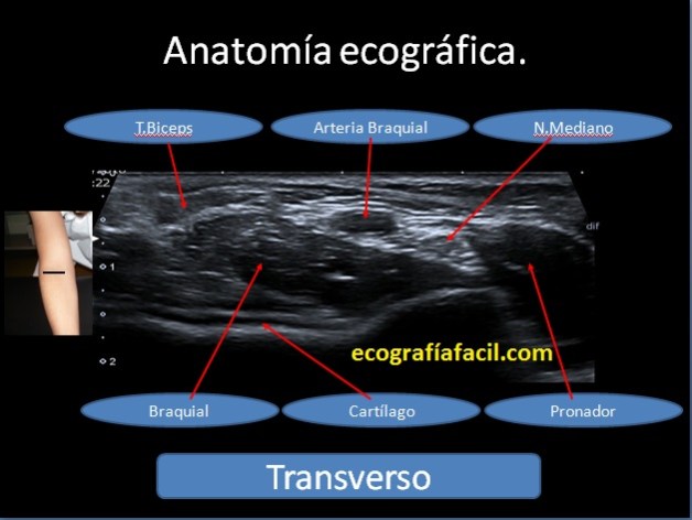 Hiperecogénico – Ecografía Fácil