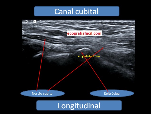 Hiperecogénico – Ecografía Fácil