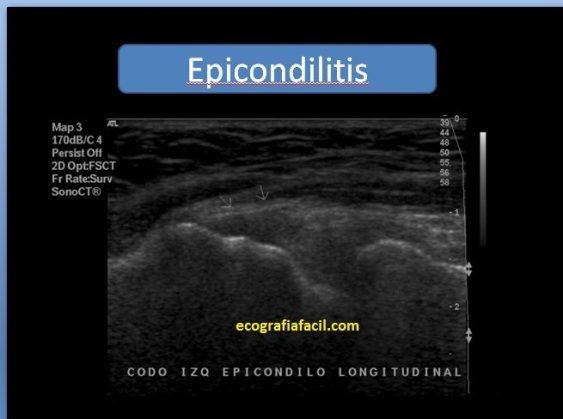 La Ecogenicidad – Ecografía Fácil