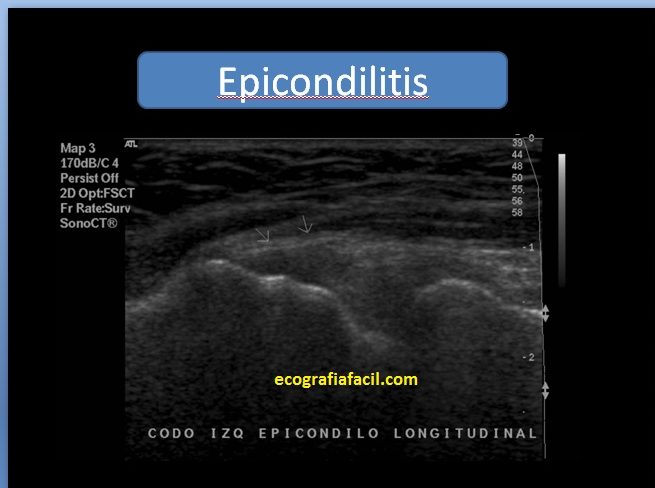 La Ecogenicidad – Ecografía Fácil